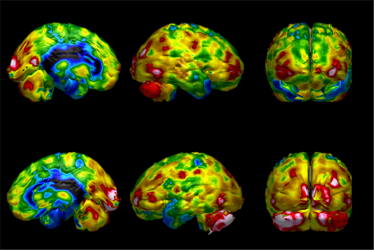 Traumatic Brain Injury Symptoms & Detection | Aviv Clinics USA