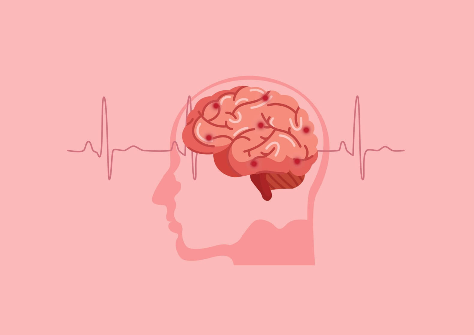 How to Prevent a Second Stroke & Other FAQs | Aviv Clinics